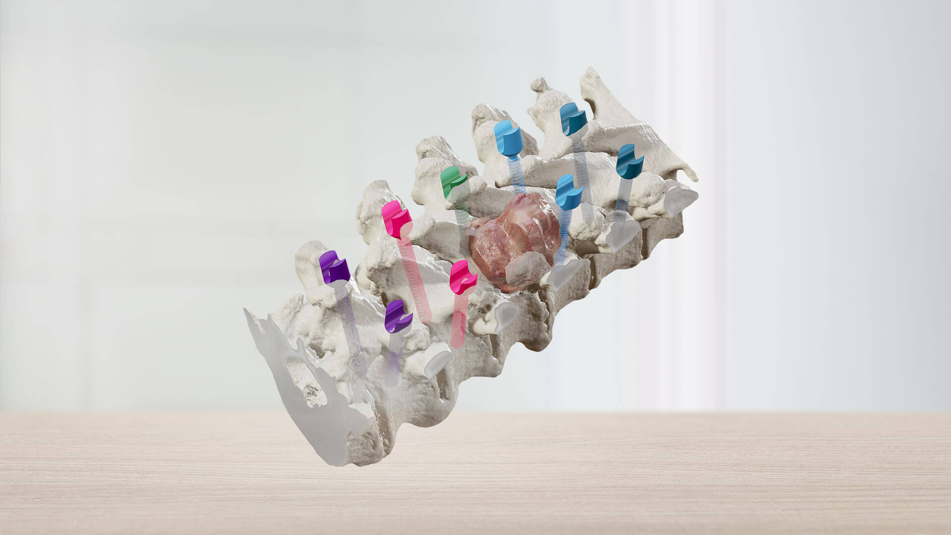 Mixed Reality Viewer: 3D Spine Surgical Planning | Brainlab